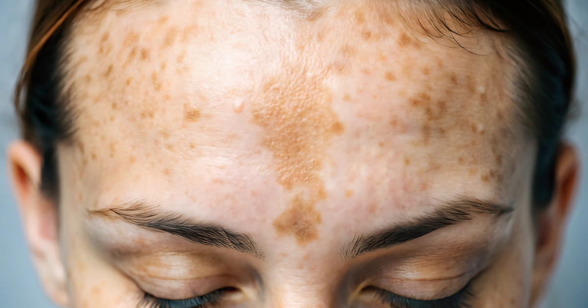 Hyperpigmentation 101: What It Is, Why It Happens, and How to Treat It | Twentyeight Health